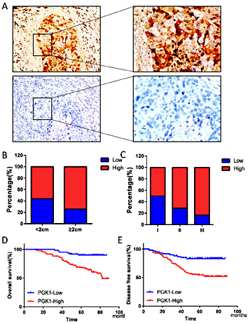PGK1 is a Potential Survival Biomarker and Invasion Promoter by ...