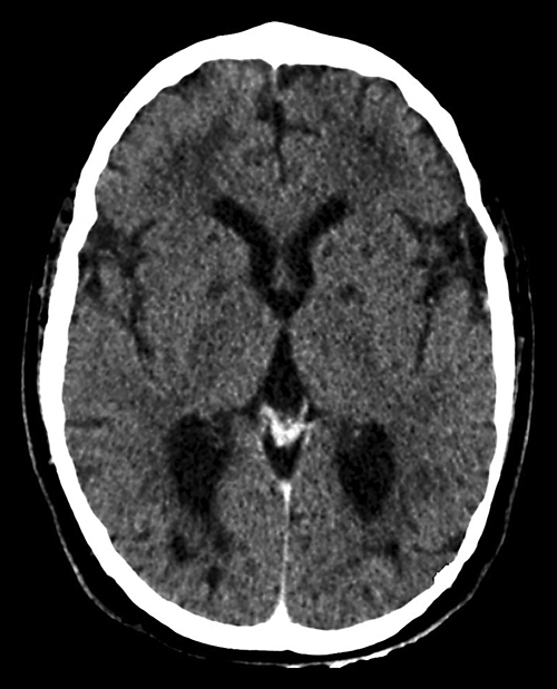 Bilateral Basal Ganglia Lesions in Patients with Heroin Overdose: A ...
