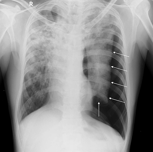 Spontaneous Tuberculosis-Associated Tension Pneumothorax: A Case Report ...