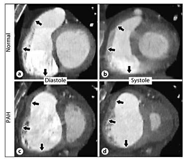 The Right Ventricle in Health and Disease: Insights into Physiology ...