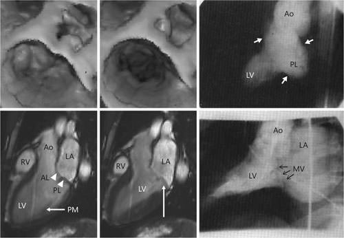 Floppy Mitral Valve (FMV)/Mitral Valve Prolapse (MVP) and the FMV/MVP ...