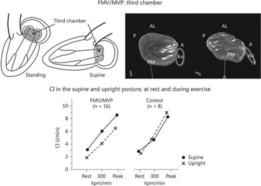 Floppy Mitral Valve (FMV)/Mitral Valve Prolapse (MVP) and the FMV/MVP ...