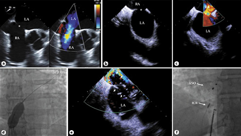 Atrial Septal Defect Sizing and Transcatheter Closure | Cardiology ...