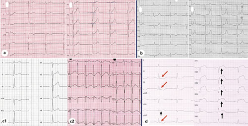 Natural Course of Electrocardiogram Changes and the Value of ...