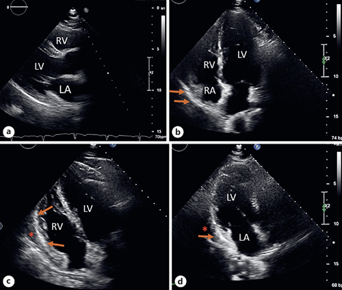 Natural Course of Electrocardiogram Changes and the Value of ...