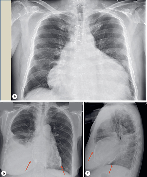 Natural Course of Electrocardiogram Changes and the Value of ...