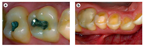 Dental Erosion – An Overview with Emphasis on Chemical and ...