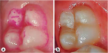 Caries Process on Occlusal Surfaces: Evolving Evidence and ...