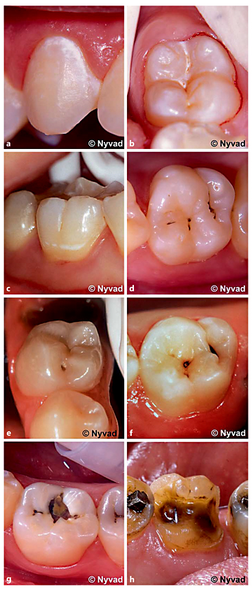 Nyvad Criteria for Caries Lesion Activity and Severity Assessment: A ...