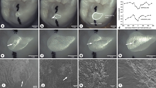 New Theory Illustrates the Formation of Enamel CUP-Shaped Lesions on ...
