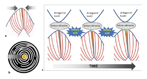 New Theory Illustrates the Formation of Enamel CUP-Shaped Lesions on ...
