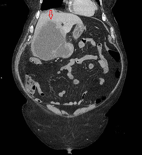 Two Anomalies in One: A Rare Case of an Intrahepatic Gallbladder with a ...