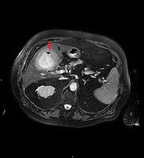 Two Anomalies in One: A Rare Case of an Intrahepatic Gallbladder with a ...
