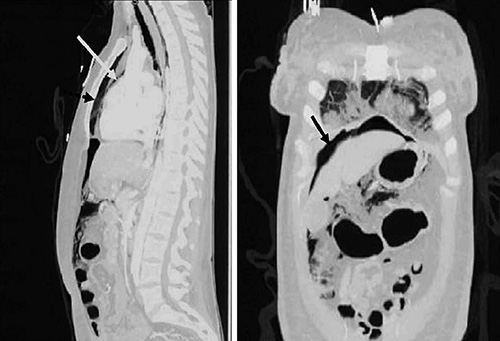 Recognition of Extraperitoneal Colonic Perforation following ...