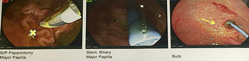 Sump Syndrome: A Rare Long-Term Complication of Choledochoduodenostomy ...