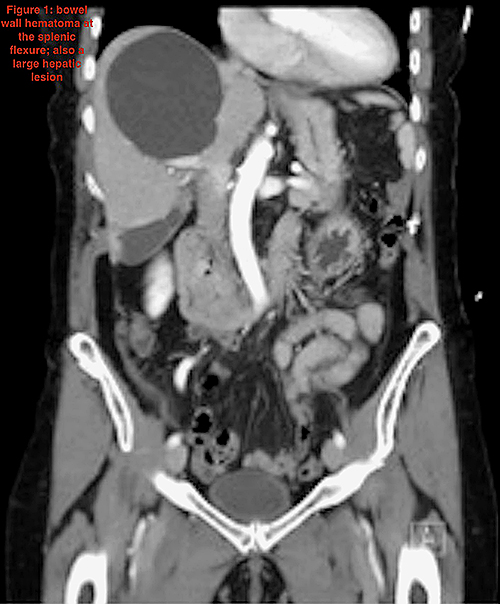 Postpolypectomy Intramural Colonic Hematoma: The Conservative ...