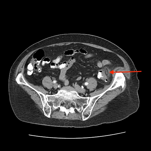 Epiploic Appendagitis: An Often Misdiagnosed Cause of Acute Abdomen ...