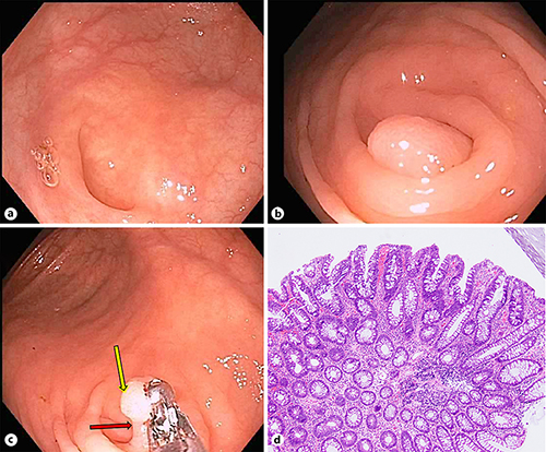 “Obscure” Appendiceal Orifice Polyps Can Be Challenging to Identify by ...