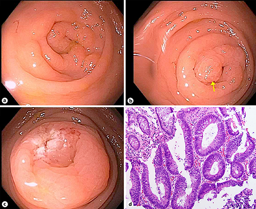“Obscure” Appendiceal Orifice Polyps Can Be Challenging to Identify by ...