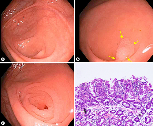 “Obscure” Appendiceal Orifice Polyps Can Be Challenging to Identify by ...