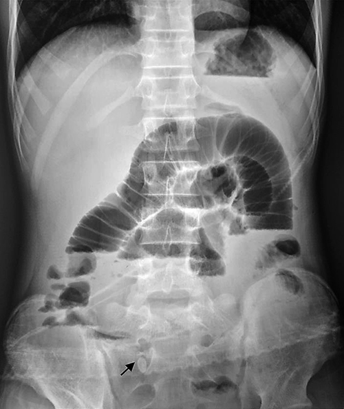 Intestinal Obstruction due to Acute Appendicitis | Case Reports in ...