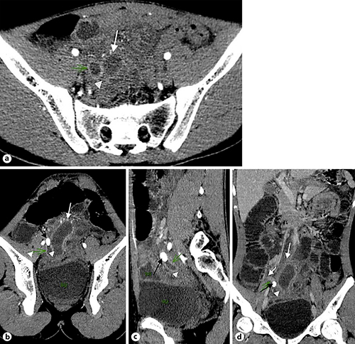 Intestinal Obstruction due to Acute Appendicitis | Case Reports in ...
