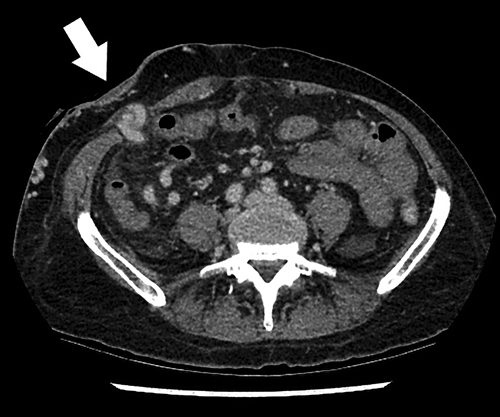 Use of Non-Selective Beta-Blocker for Refractory Stomal Variceal ...