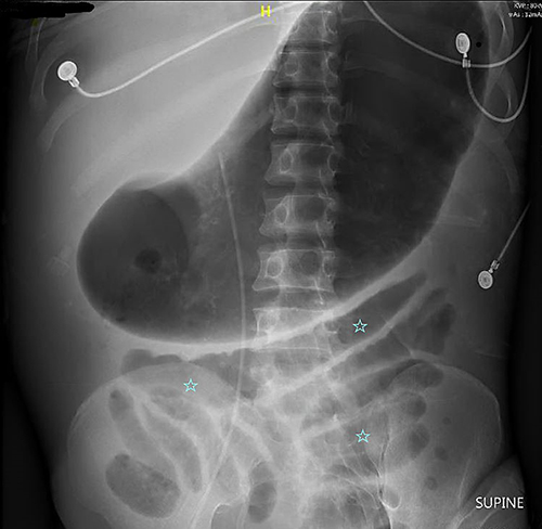 Acute Gastric Dilatation: A Cause for Concern | Case Reports in ...