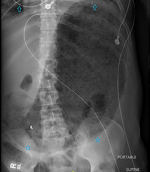 Acute Gastric Dilatation: A Cause for Concern | Case Reports in ...