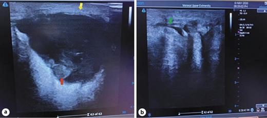 Omphalitis with Umbilical Abscess in an Adult with a Urachal Remnant ...