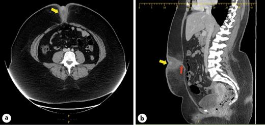 Omphalitis with Umbilical Abscess in an Adult with a Urachal Remnant ...