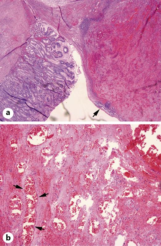 Cavernous Gastric Hemangioma as an Unusual Cause of Upper ...