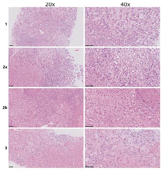Acute Liver Injury and Acute Liver Failure following Bariatric Surgery ...