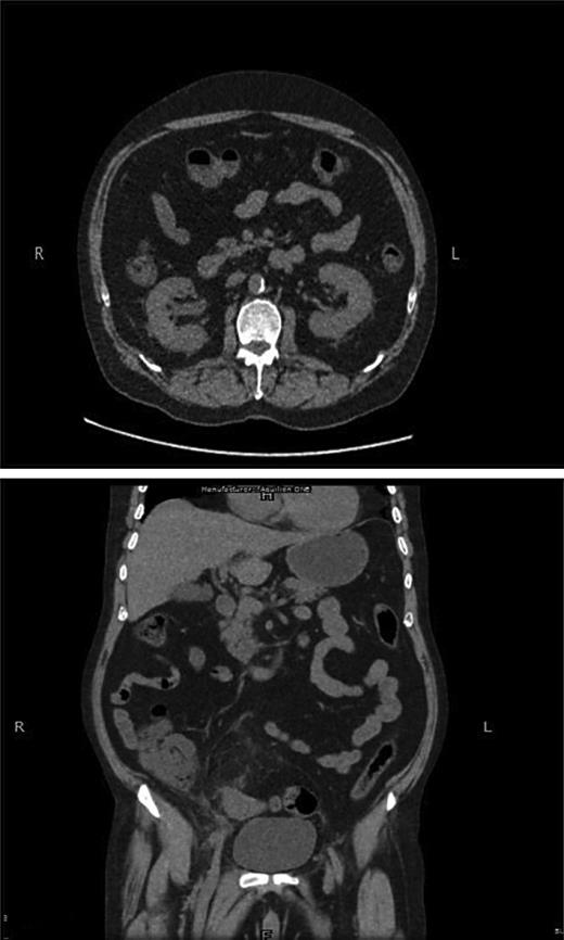 Appendicitis after Appendectomy: A Rare Presentation of Acute ...