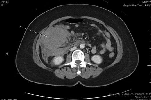 Intramural Hematoma and Retroperitoneal Hematoma Following a Routine ...