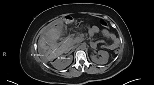 Intramural Hematoma and Retroperitoneal Hematoma Following a Routine ...