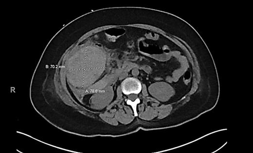 Intramural Hematoma and Retroperitoneal Hematoma Following a Routine ...
