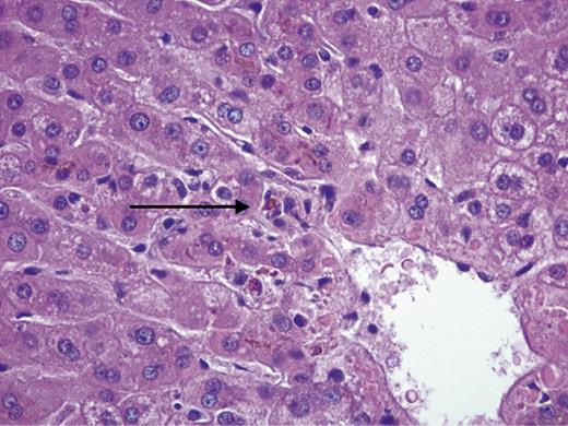 Drug-Induced Liver Injury from Herbal Liver Detoxification Tea | Case ...