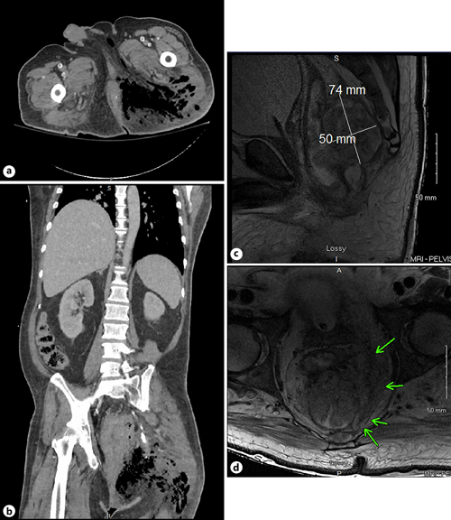 Rectal Adenocarcinoma Presenting as a Perirectal Abscess | Case Reports ...