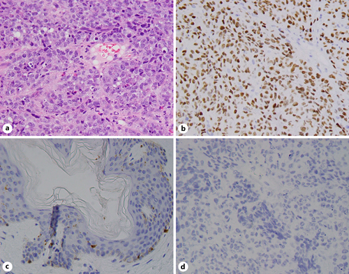 Rectal Melanoma: Rare Cancer with Grave Prognosis | Case Reports in ...