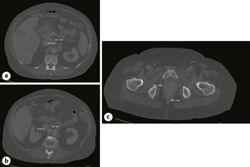 Rectal Melanoma: Rare Cancer with Grave Prognosis | Case Reports in ...