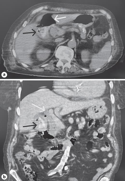 Preoperative Diagnosis and Treatment of Cholecystoduodenal Fistula ...