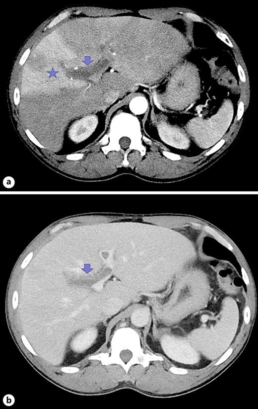Clostridium difficile Bacteremia as a Rare Presentation of ...