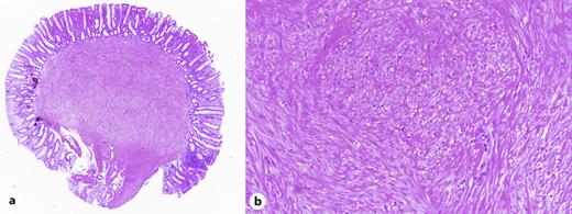 An Asymptomatic Patient with Colonic Leiomyoma | Case Reports in ...
