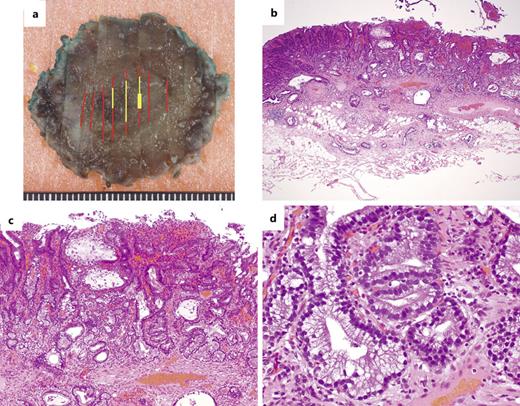 Gastric Adenocarcinoma with Enteroblastic Differentiation Resected ...