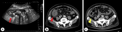 Phlegmonous Colitis after Cold Snare Polypectomy in an Immunosuppressed ...