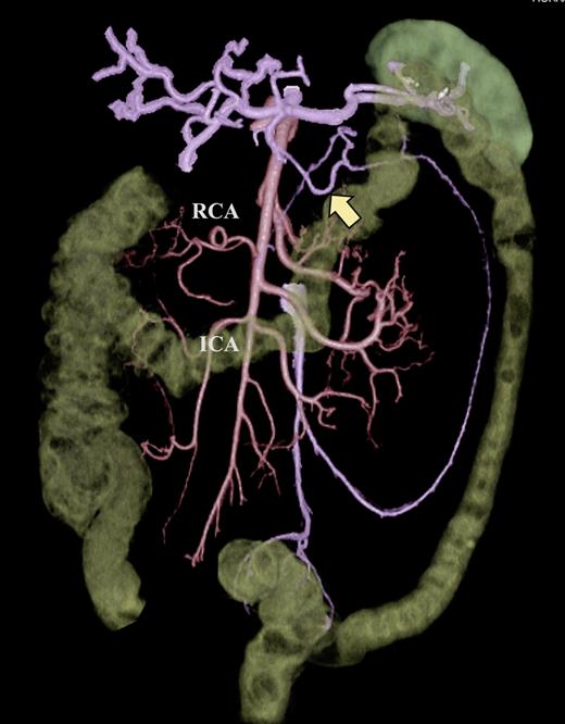 Laparoscopic Resection of Transverse Colon Cancer with an Anomaly of ...