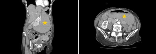 Acute Gastric Dilatation: A Retrospective Case Series from a Single ...
