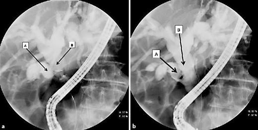 Mirizzi Syndrome with Endoscopic Ultrasound Image | Case Reports in ...