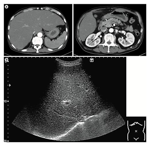 Diffuse Liver Metastasis of Small-Cell Lung Cancer Presenting as Acute ...